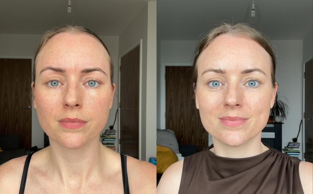 Botox Brow Lift: Truth About Results and Effectiveness